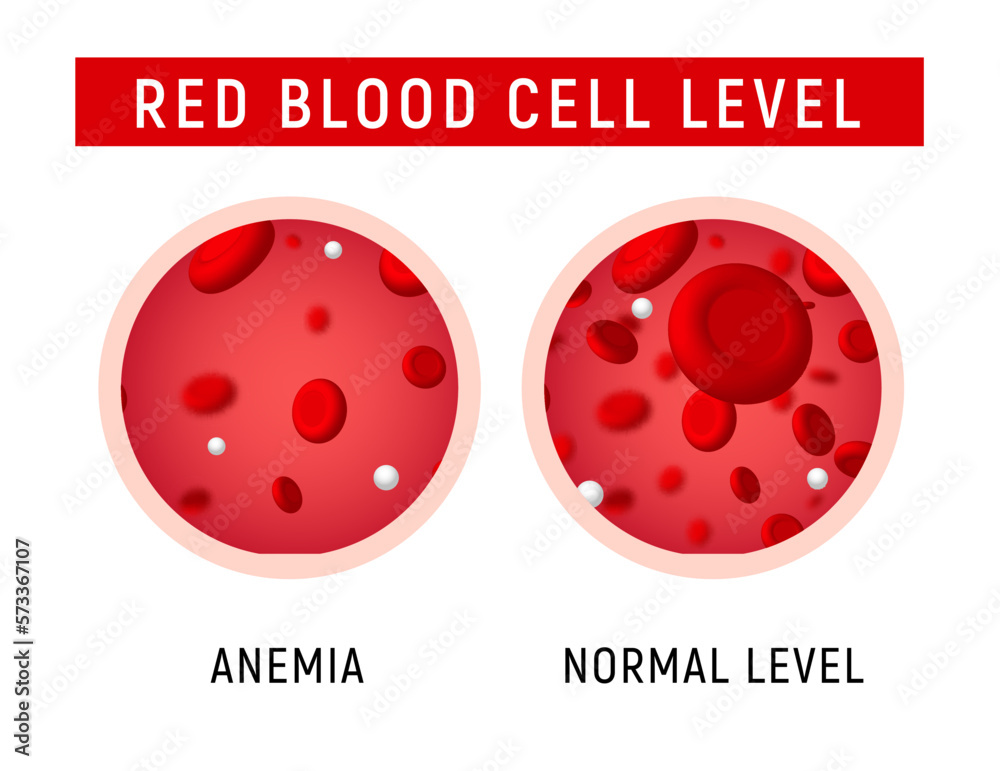 Anemia problem circulatory iron body diagram background. Anaemia ...