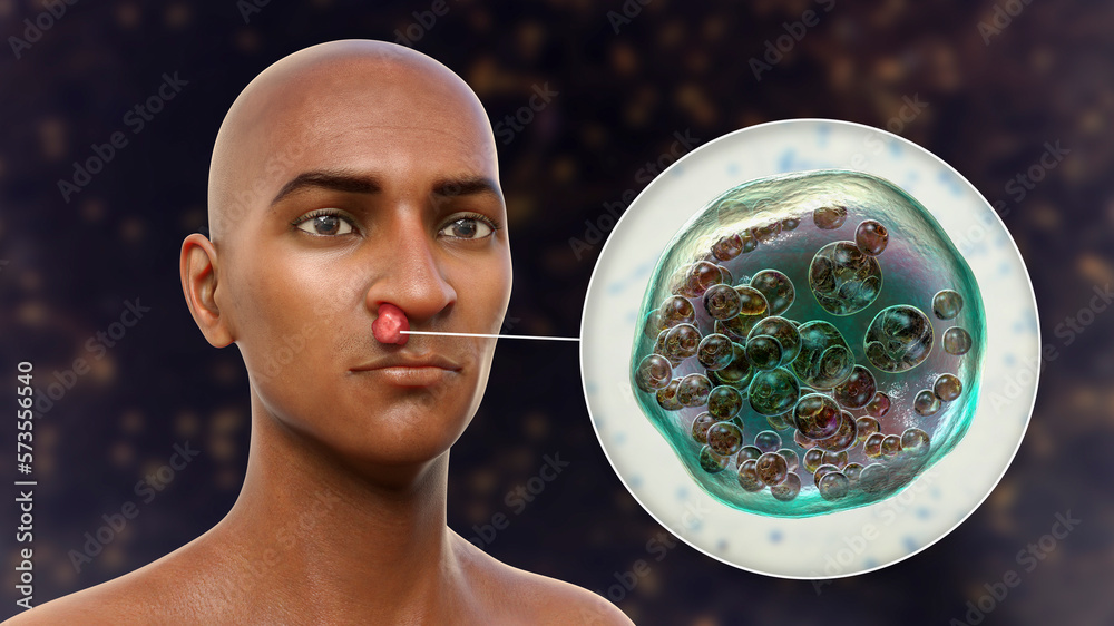 Nasal rhinosporidiosis in a patient, 3D illustration. A disease caused ...