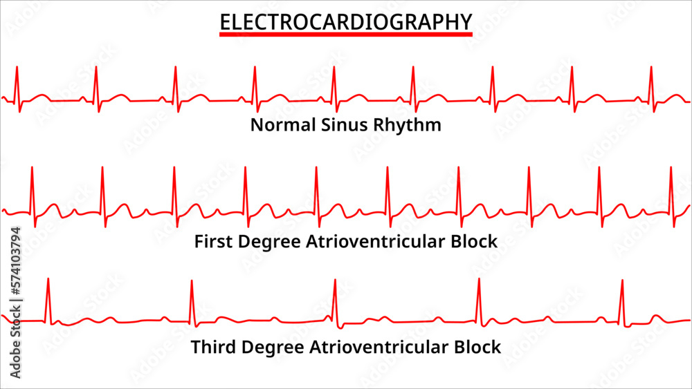 Vector de Stock Set of ECG Common Abnormalities - Normal Sinus Rhythm ...