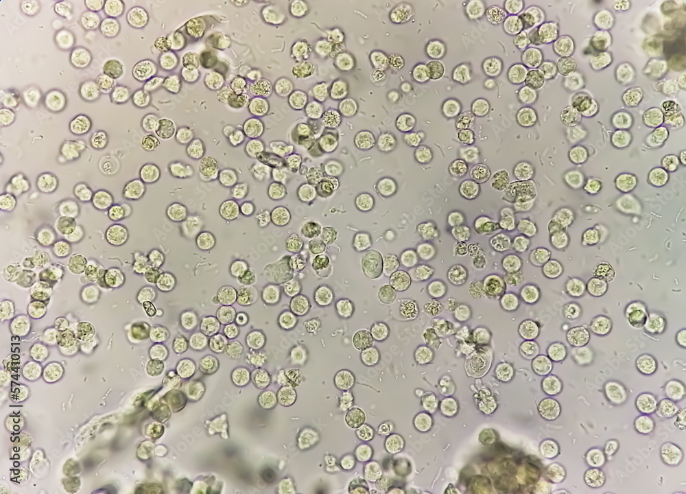 Pyuria or leukocyturia is the condition of urine containing white blood ...