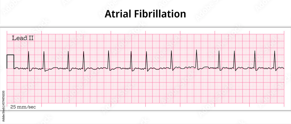 ECG Atrial Fibrillation - 8 Second ECG Paper - Electrocardiography ...