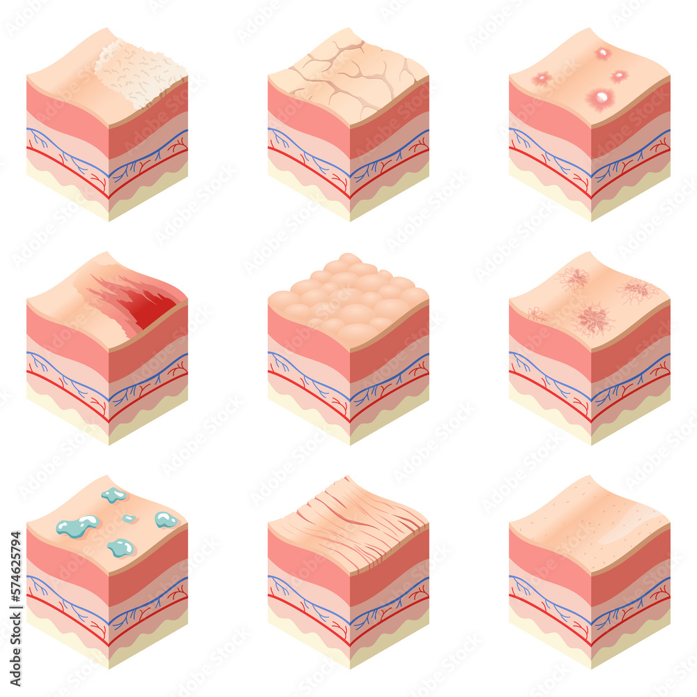 Skincare medical concept. Set of problems of different skin types in ...