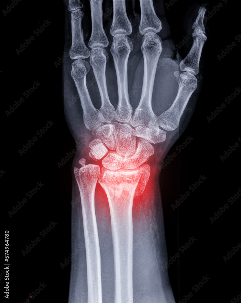 X-ray image of Left wrist joint AP and Lateral view for showing ...