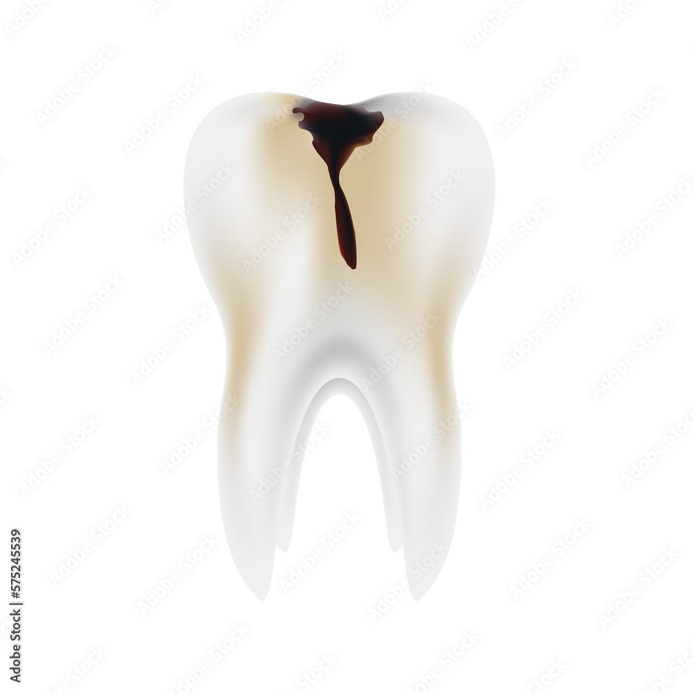 Tooth caries stages, development of teeth decay with enamel and dentin ...