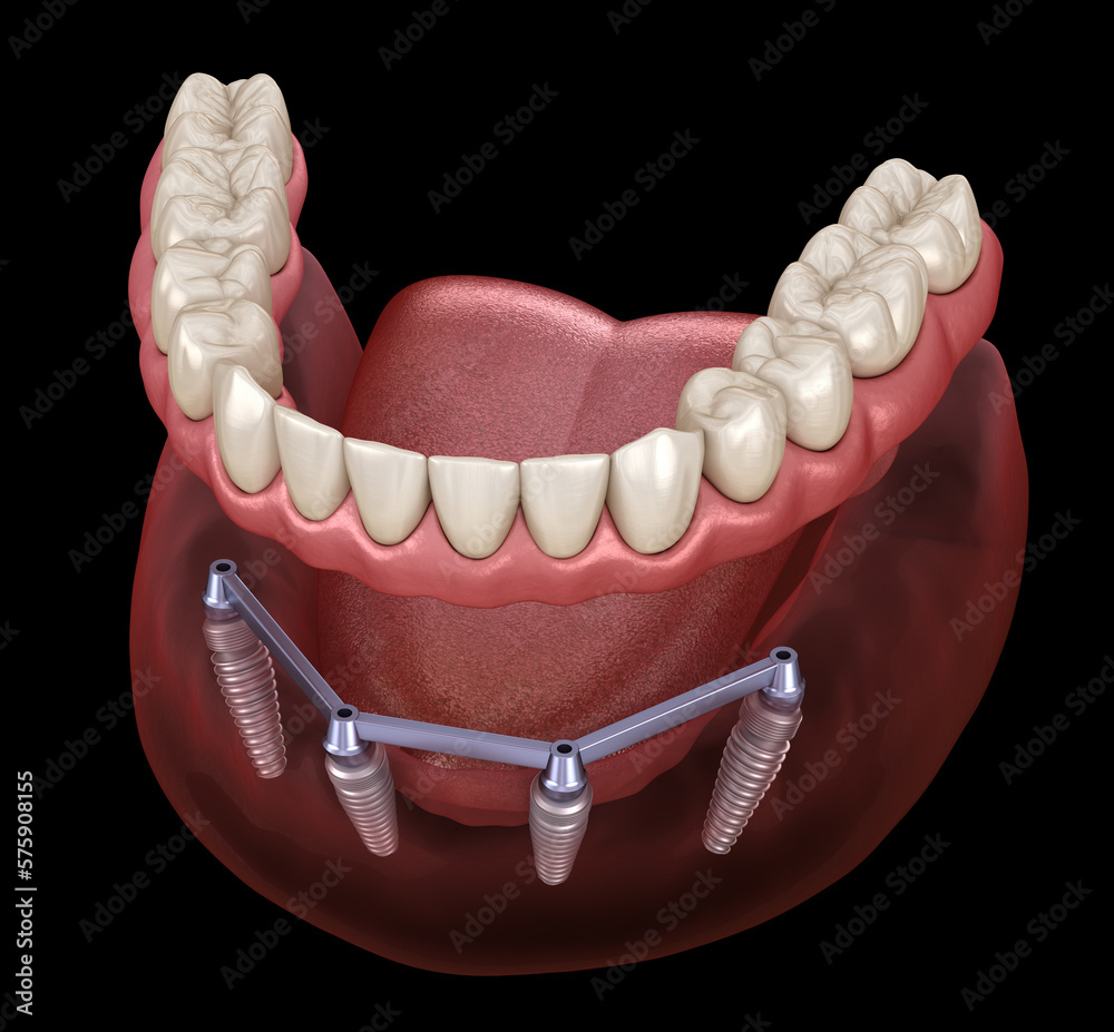 Mandibular prosthesis with gum All on 4 system supported by implants ...