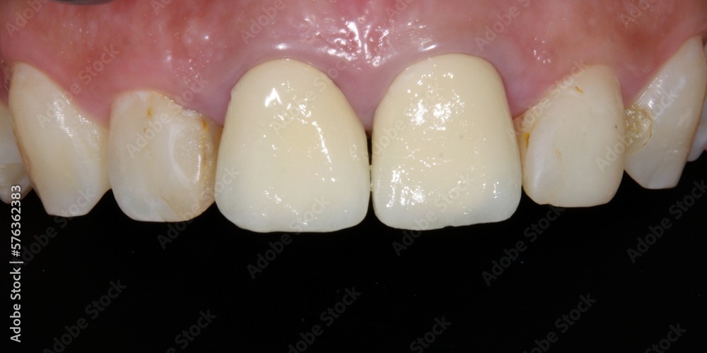 Frontal view of maxillary arch incisor and canine teeth and fixed ...