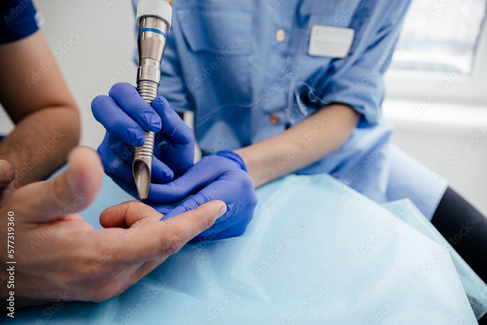 The doctor removes moles and warts with a laser beam. Mole removal ...