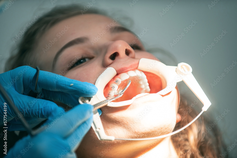 Dentist appointment at a dental clinic, placing braces locks on the ...
