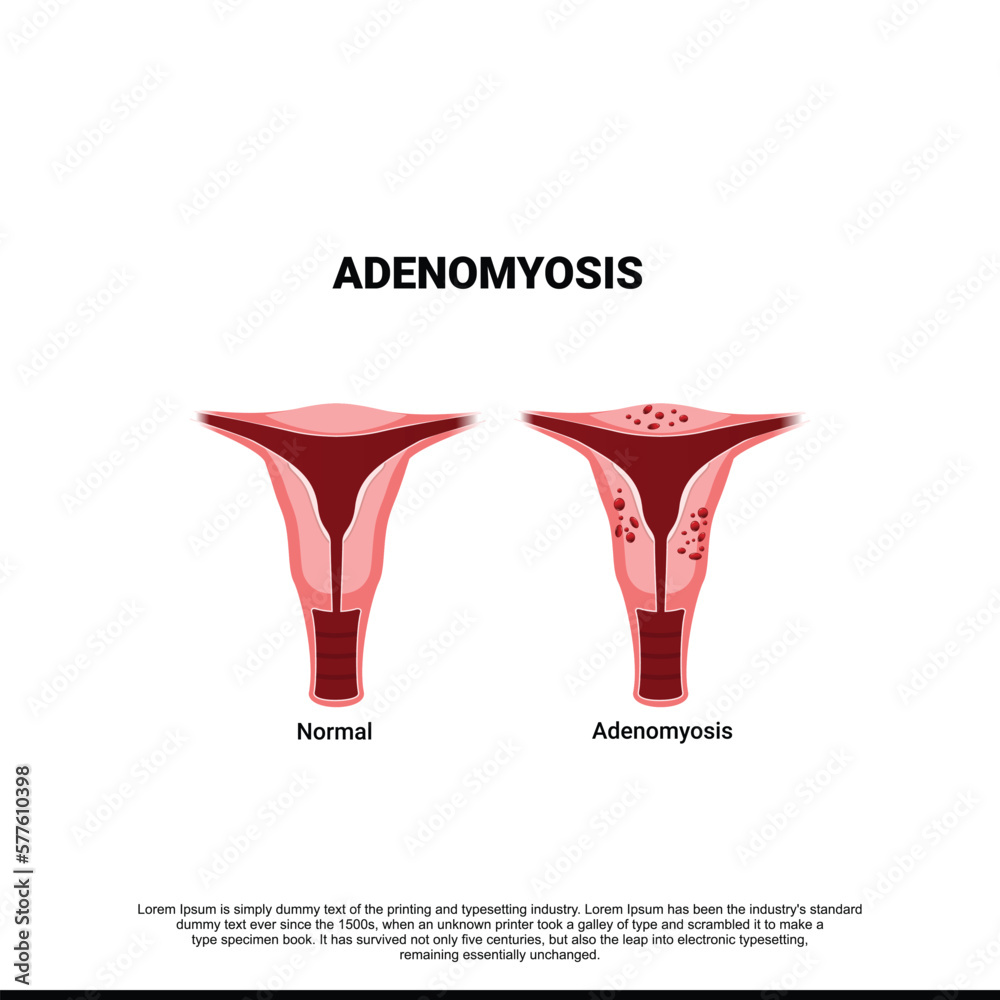Adenomyosis. Comparison normal and unhealthy abnormal women uterus ...