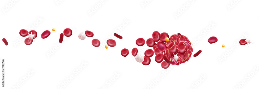 3D illustration of a blood clot in a blood vessel showing a blocked ...