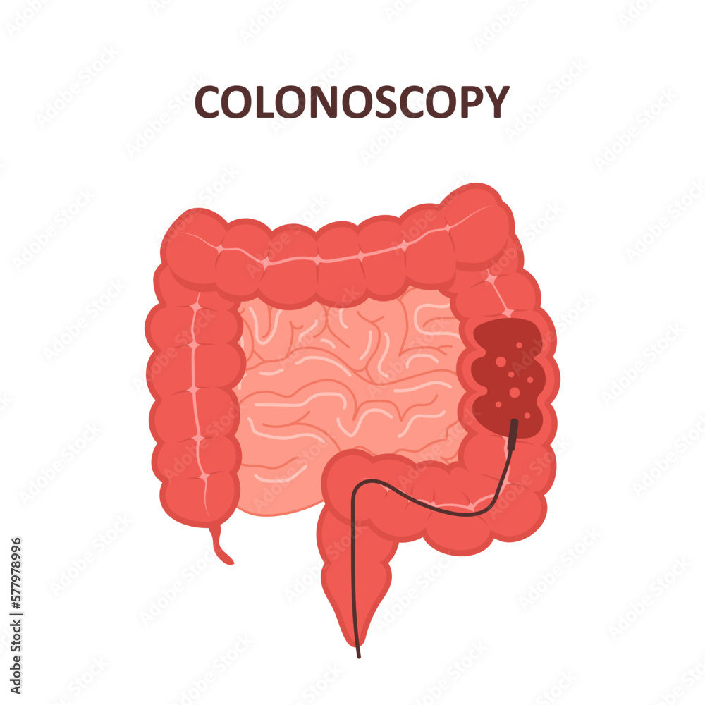 Colonoscopy procedure. Intestine exam and treatment. Colon polypectomy ...