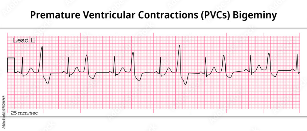 Bigeminy Premature Ventricular Contractions (PVCs) - Ventricular ...