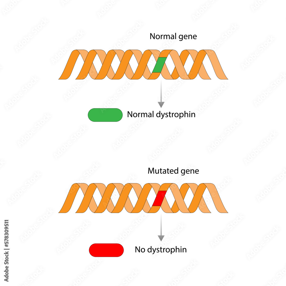 Muscular dystrophy ,MD, Duchenne MD syndrome, mutations in genes ...