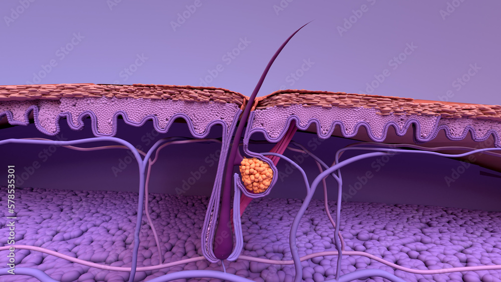 Formation of skin acne or pimple. The sebum in the clogged pore ...