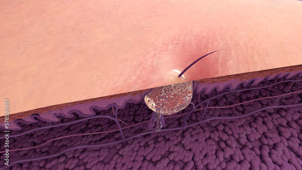 Formation of skin acne or pimple. The sebum in the clogged pore ...