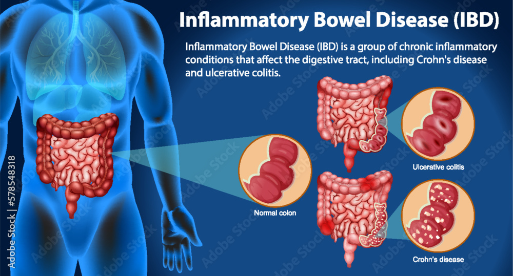 Inflammatory Bowel Disease (IBD) Infographic Stock Vector | Adobe Stock