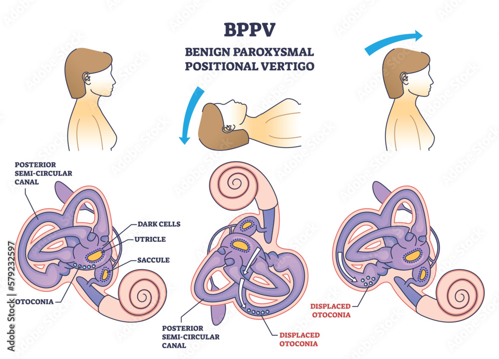 Vetor BPPV or benign paroxysmal positional vertigo syndrome outline ...