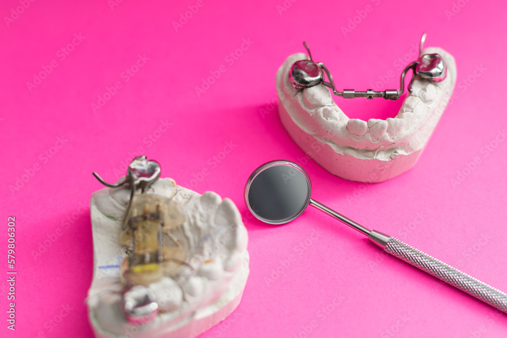 Dental casting gypsum model of human jaws. Crooked teeth and distal ...