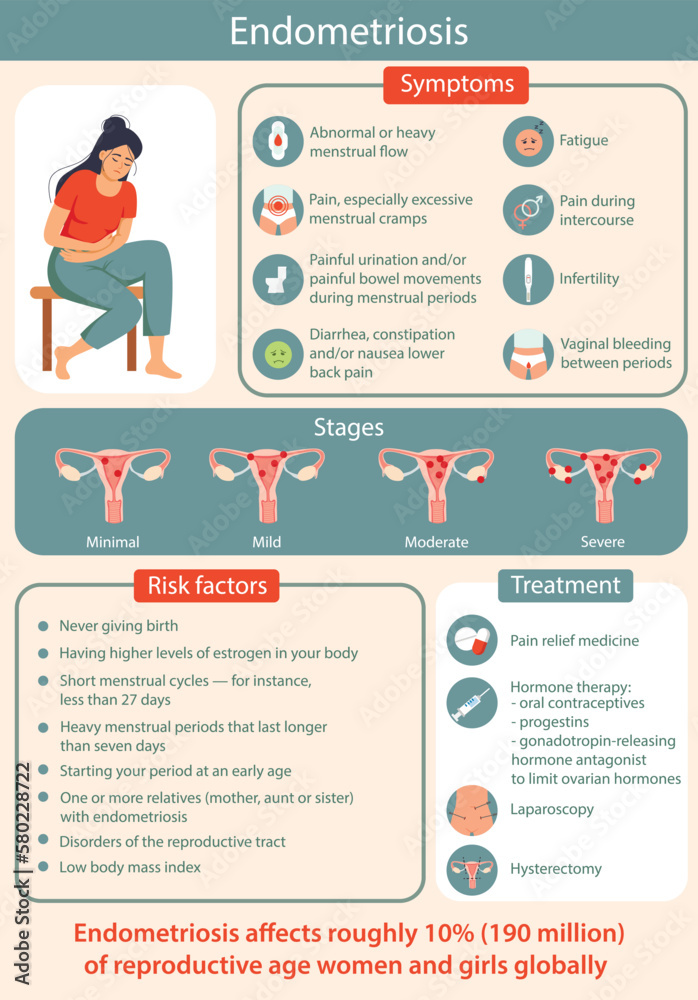 Endometriosis infographic. Detailed vector Infographic. Women Health Stock Vector | Adobe Stock