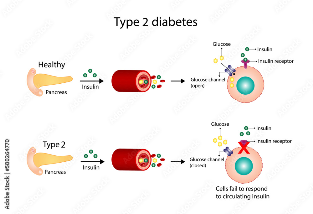 Diabetes mellitus type 2, cells fail to respond to insulin (Insulin ...