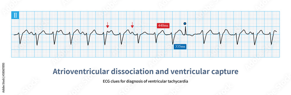 If atrioventricular dissociation and ventricular capture are found ...