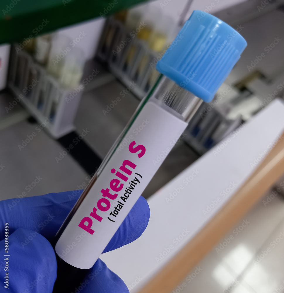 Blood sample for protein S total activity test to diagnosis of ...
