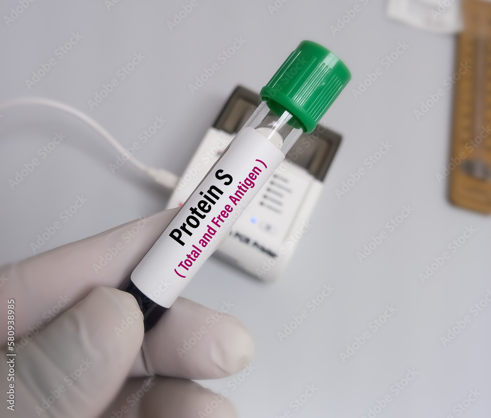 Blood sample for protein S total and free antigen test to diagnosis of ...