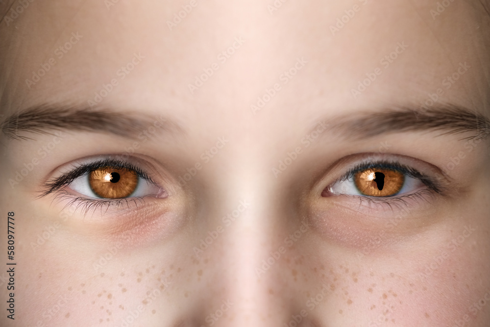 congenital colaboma of iris, pear-shaped black spot, chromosomal abnormalities, poor heredity ...