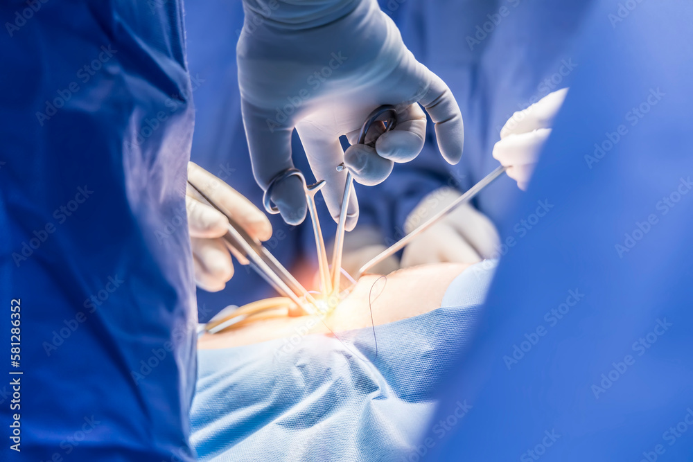 Surgeon or doctor in blue uniform did surgery in surgical hospital with ...