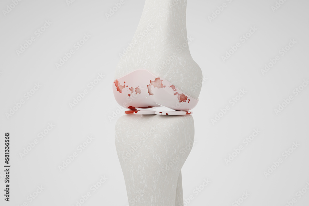 Knee osteoarthritis isolated white background 3D rendering. Stock ...