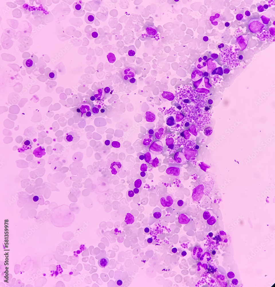 Hereditary hemolytic anemia. Hemoglobin E (HbE) disease. Smear show 90 ...