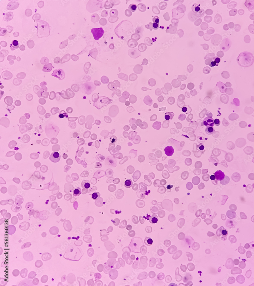 Hereditary hemolytic anemia. Hemoglobin E (HbE) disease. Smear show 90 ...