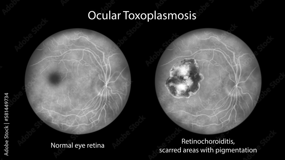 Retinal scar caused by a Toxoplasma gondii infection, or toxoplasmosis ...