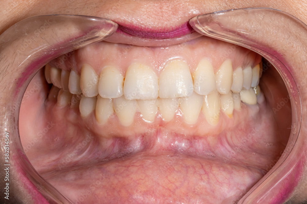 Front view of dental arches in occlusion, lips and cheeks retracted ...