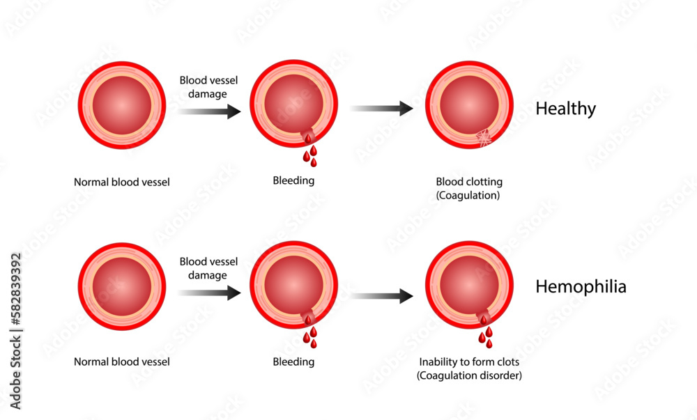 Vector de Stock Hemophilia, a bleeding disorder that slows the blood clotting. Haemophilia ...