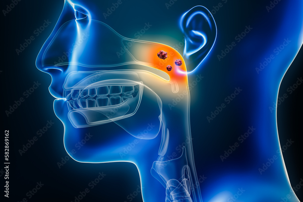 Illustration Stock Nasopharynx cancer with organs and tumors or ...