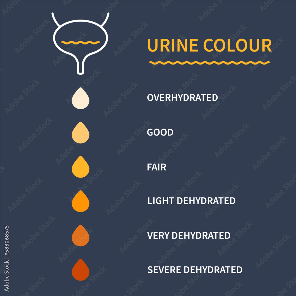 Urine color chart diagram. Bladder with urine drops showing different ...