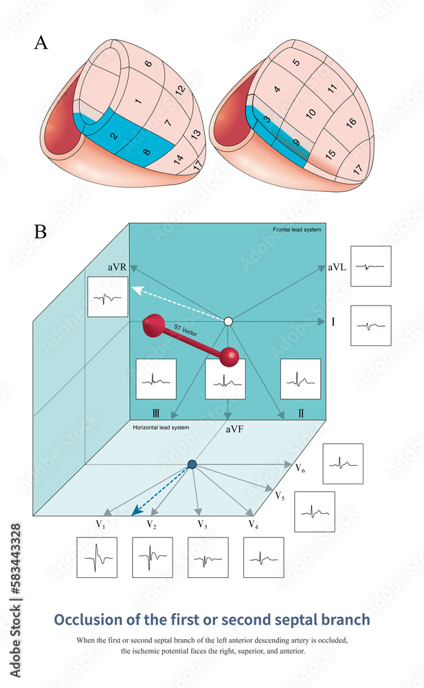 Stock-Illustration „When the isolated first or second septal branch is ...