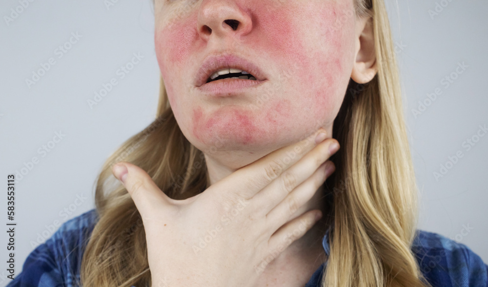 Rosacea face. The girl suffers from redness on her cheeks. Couperosis ...