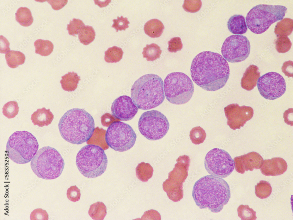 Leukemia, blood cells, blast cells in Acute myeloid Leukemia (AML ...