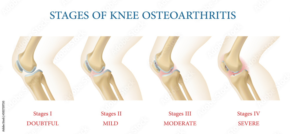 Medical infographics. Knee joint osteoarthritis stages, vector chart of ...