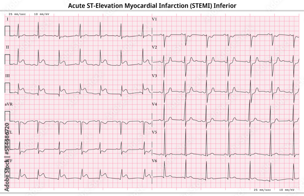 ECG Acute STEMI (ST-Elevation Myocardial Infarction) - 12 Lead ECG ...