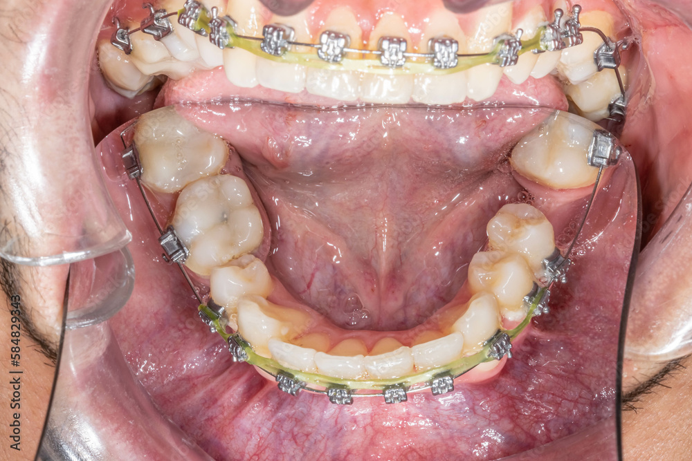 Stock-Foto „Dental orthodontics patient. Mirror indirect occlusal view ...