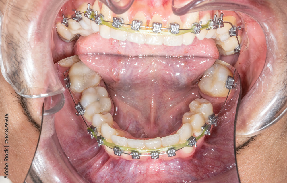 Dental orthodontics patient. Mirror indirect occlusal view of the ...