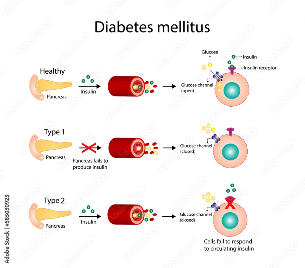 Diabetes mellitus type 1, pancreas's failure to produce enough insulin ...