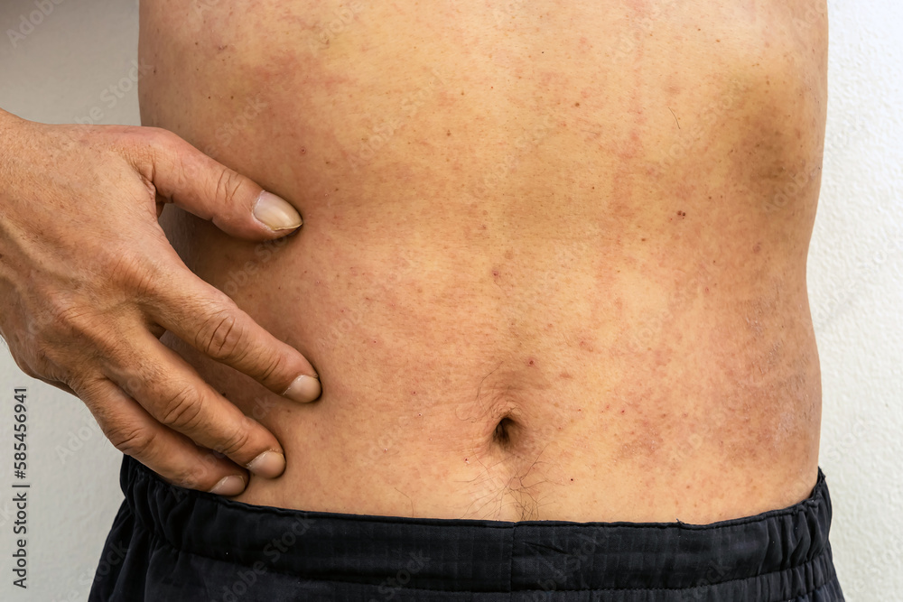 Man hand scratching an itch on red mark sensitive skin. Male torso with ...