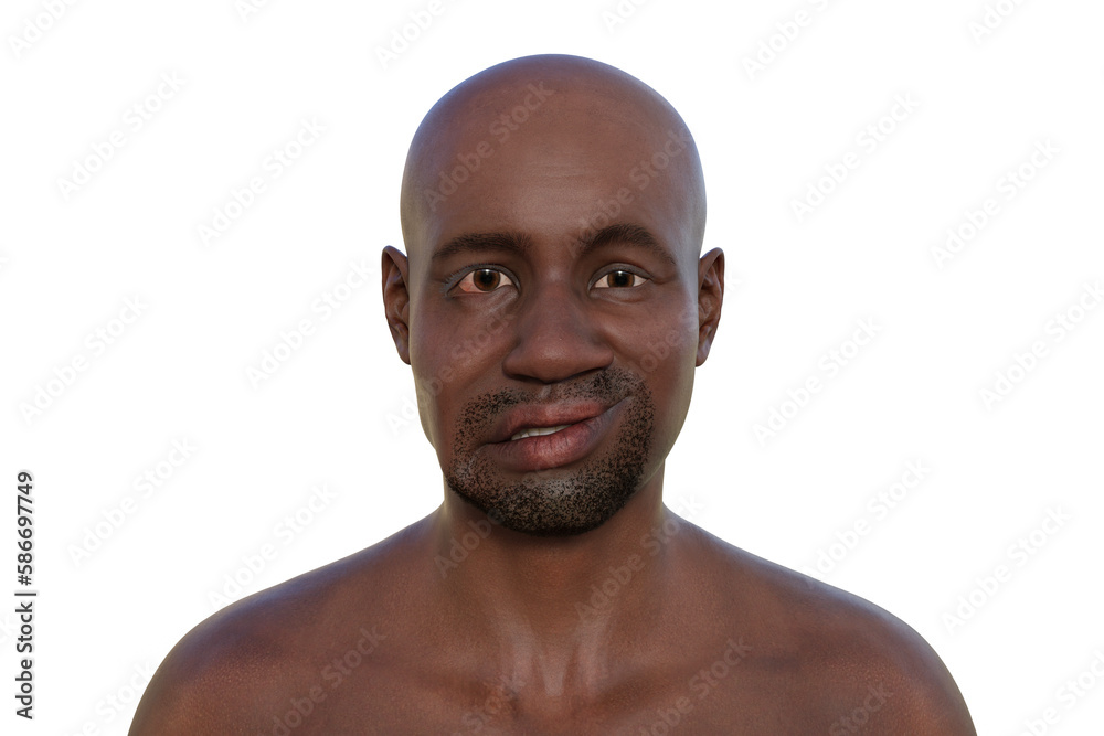 Facial palsy in an African man, 3D illustration highlighting the ...