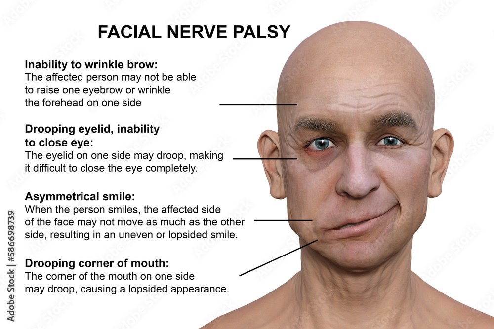 Facial palsy in a man, 3D illustration highlighting the asymmetry and ...
