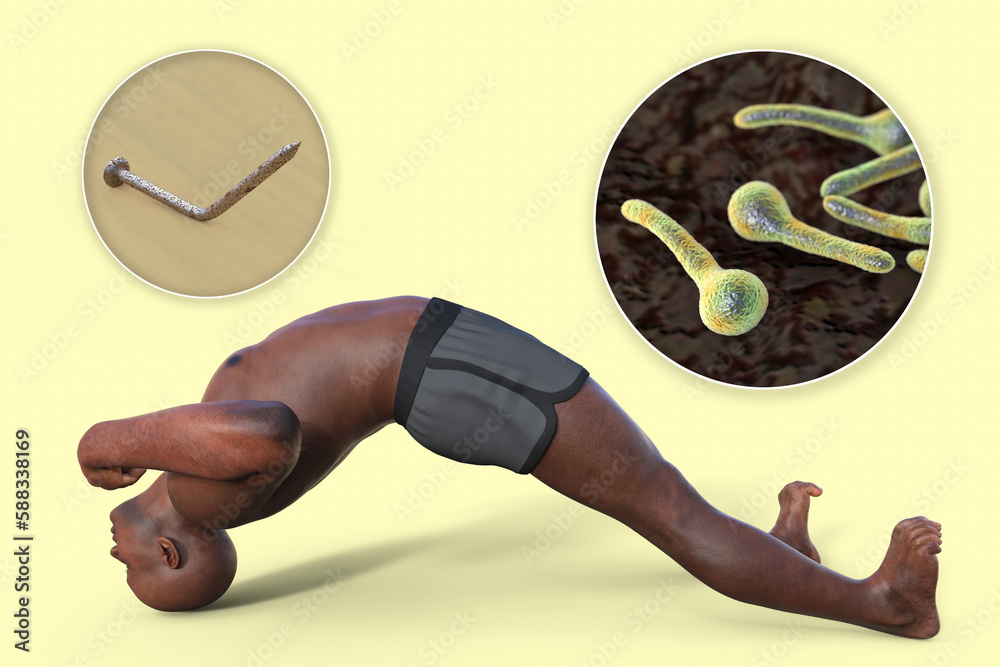 A 3D medical illustration of a black-skinned man suffering from tetanus ...