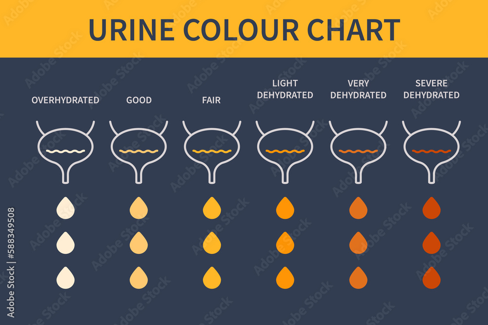 Urine color chart diagram. Bladders with urine drops showing different ... Urine color chart diagram. Bladders with urine drops showing different ...